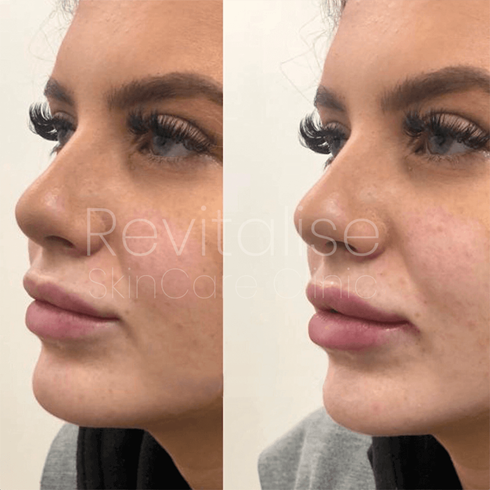 The BEST lip fillers in Bath and Wiltshire - Revitalise Skincare Clinic