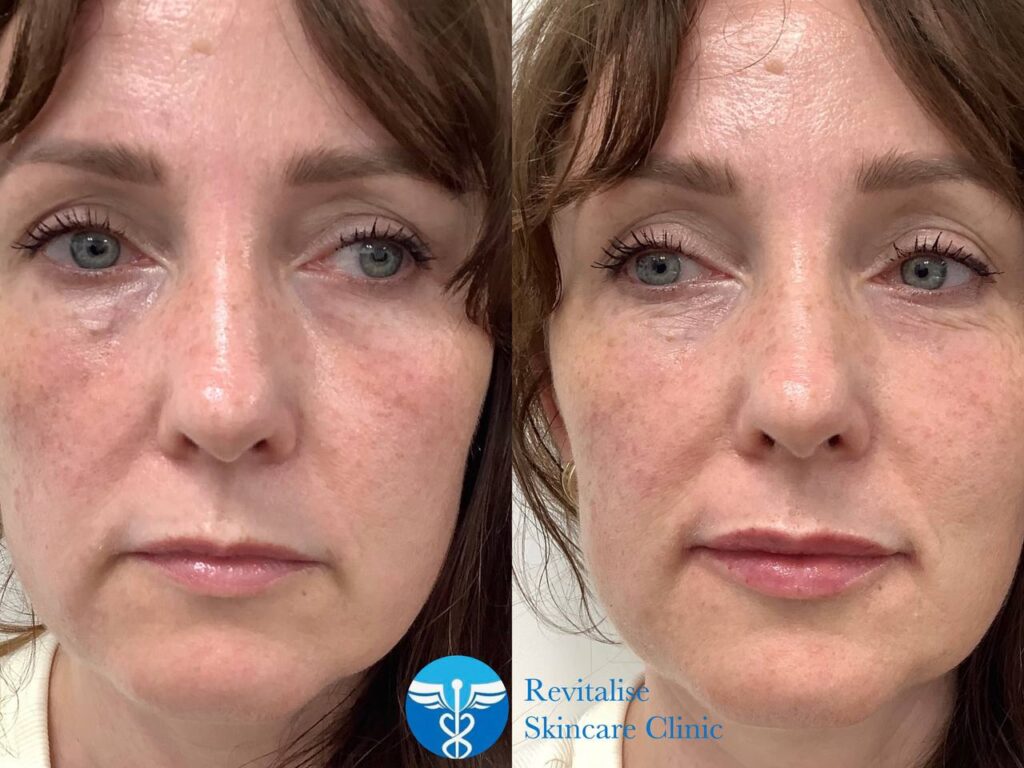 The BEST lip fillers in Bath and Wiltshire - Revitalise Skincare Clinic
